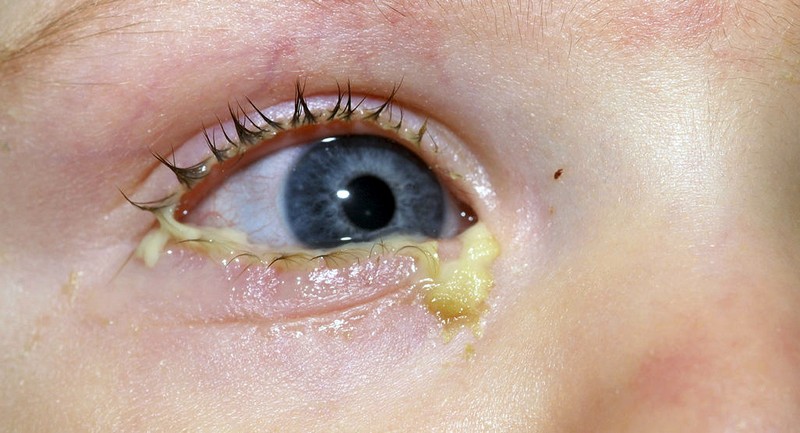 konjuktivitis-bebinja (1) - Pedijatar.mk