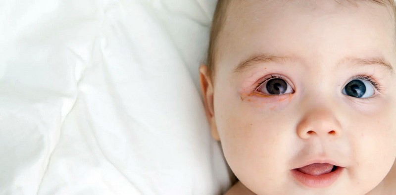 konjuktivitis-bebinja (2) - Pedijatar.mk